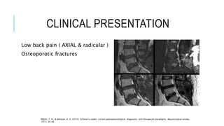 Schmorl's Nodes | PPTX