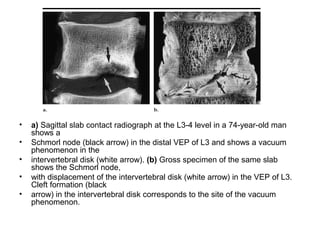 Schmorl’s nodes (spine 2010) | PPT