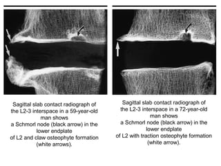 Schmorl’s nodes (spine 2010) | PPT