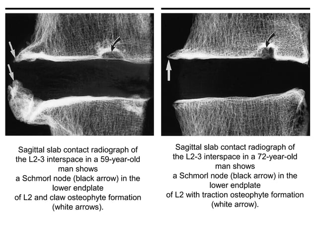 Schmorl’s nodes (spine 2010) | PPT