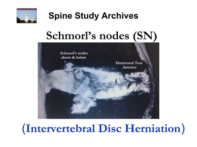 Schmorl’s nodes (spine 2010) | PPT