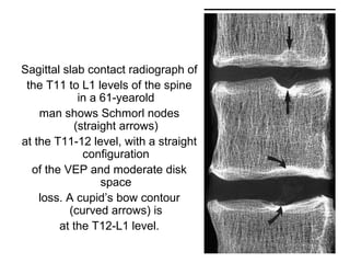 Schmorl’s nodes (spine 2010) | PPT