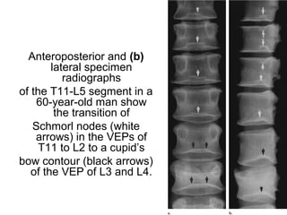 Schmorl’s nodes (spine 2010) | PPT