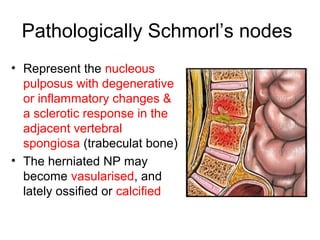 Schmorl’s nodes (spine 2010) | PPT