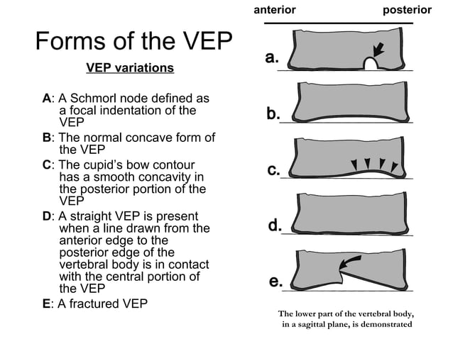 Schmorl’s nodes (spine 2010) | PPT
