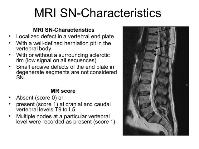 Schmorl’s nodes (spine 2010)