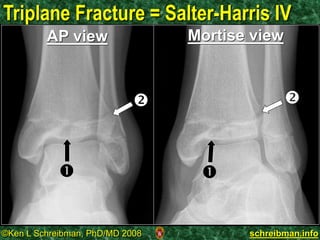 Ankle twisting injuries MSK Radiology | PPSX