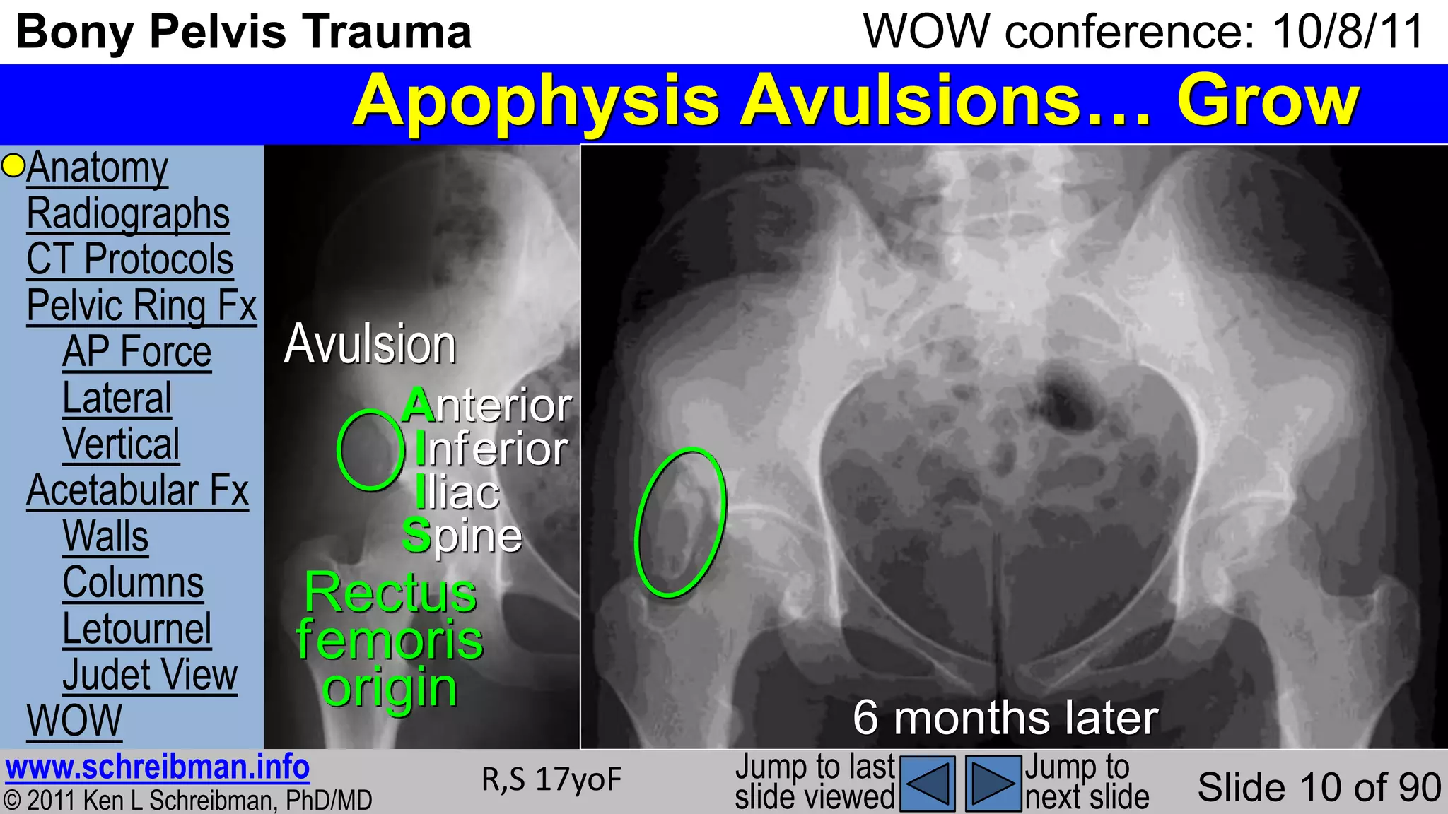 Bony Pelvis Trauma MSK Radiology Lecture | PPSX