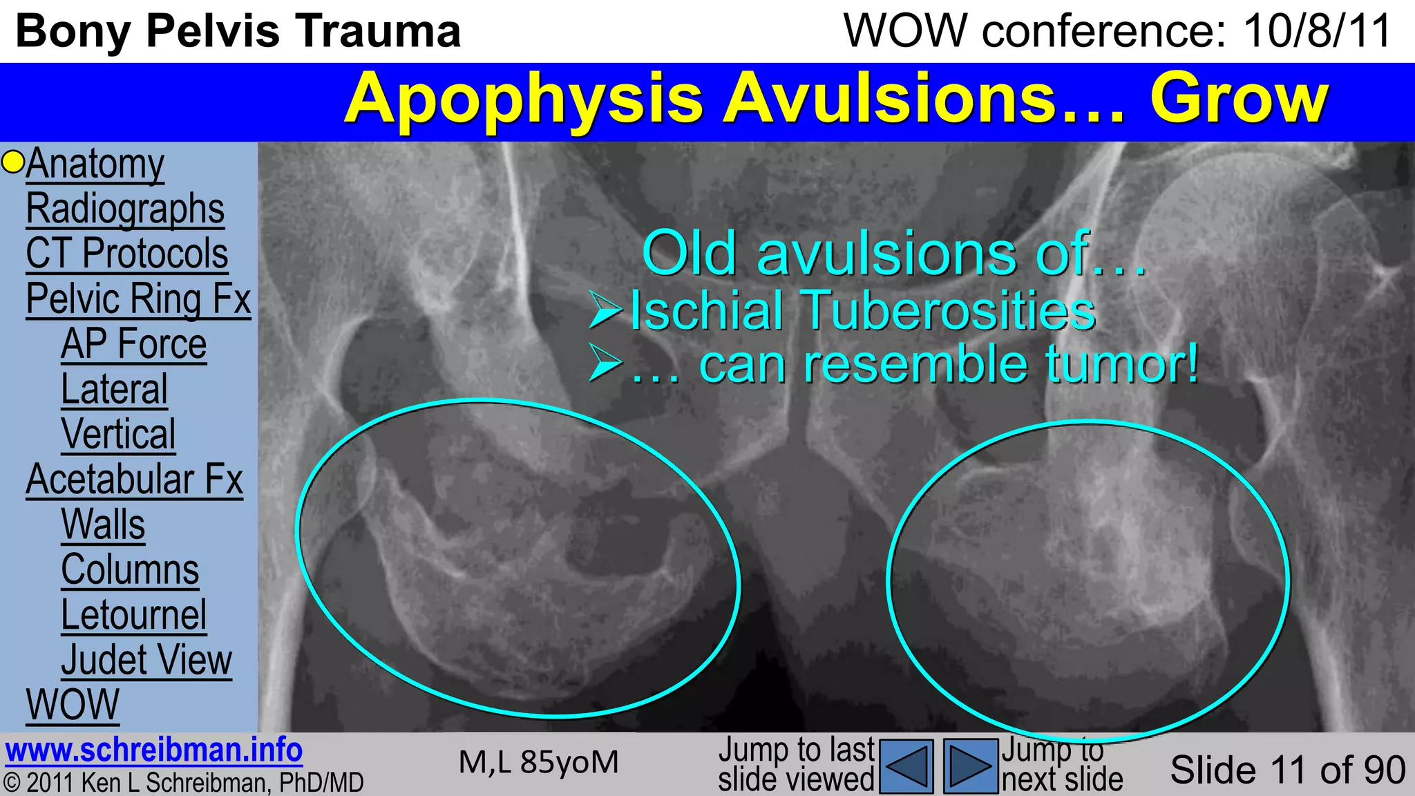 Bony Pelvis Trauma MSK Radiology Lecture | PPSX