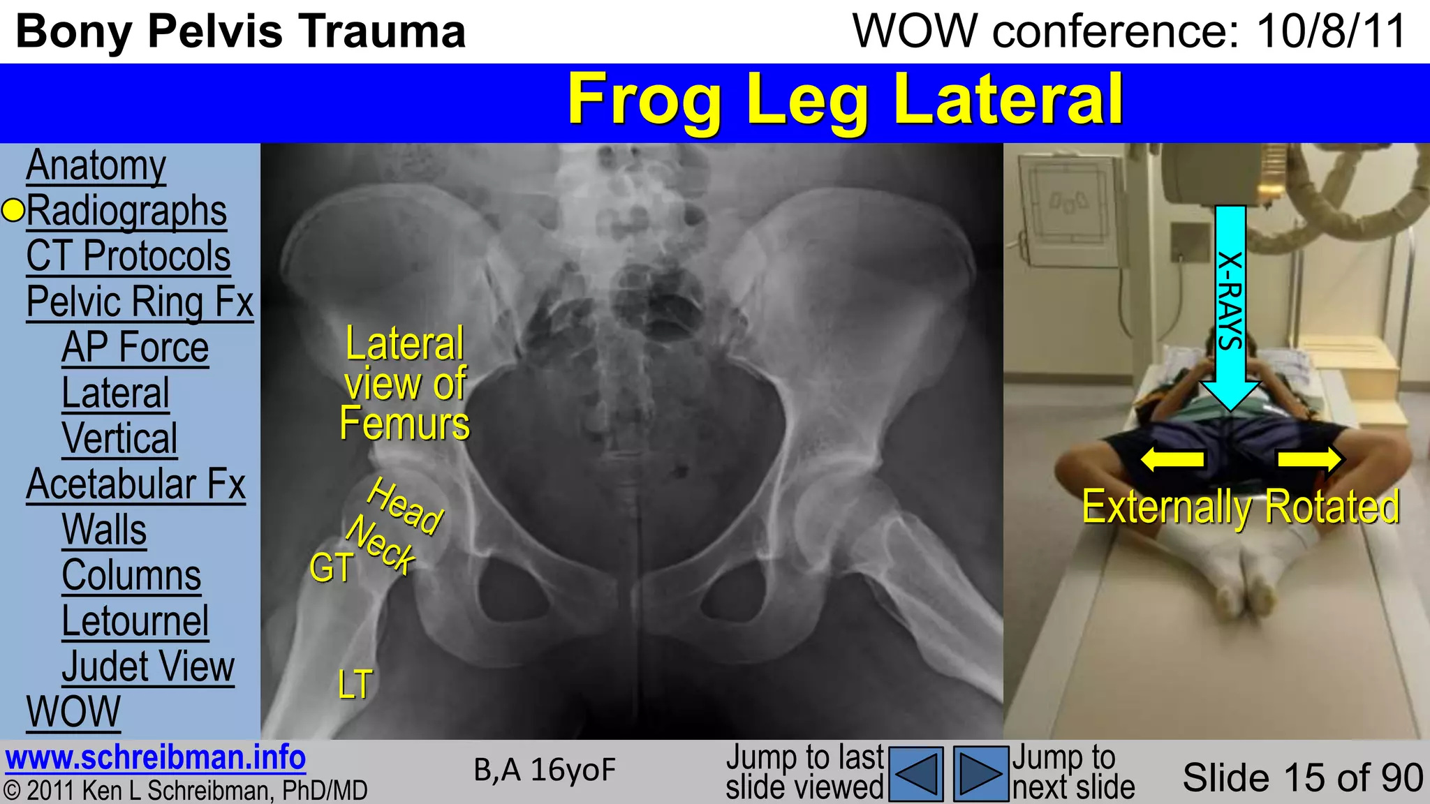 Bony Pelvis Trauma MSK Radiology Lecture | PPSX