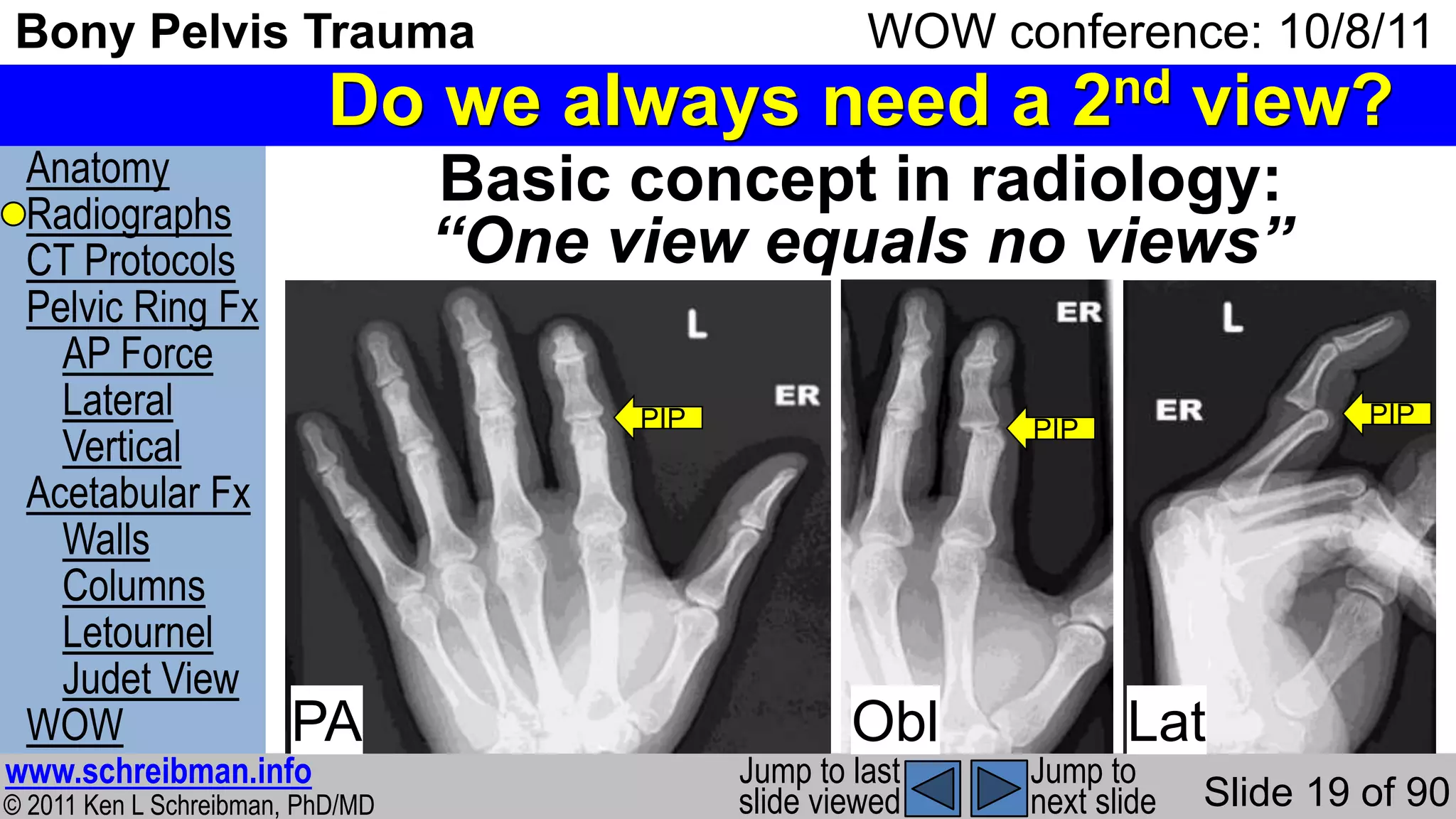 Bony Pelvis Trauma MSK Radiology Lecture | PPSX