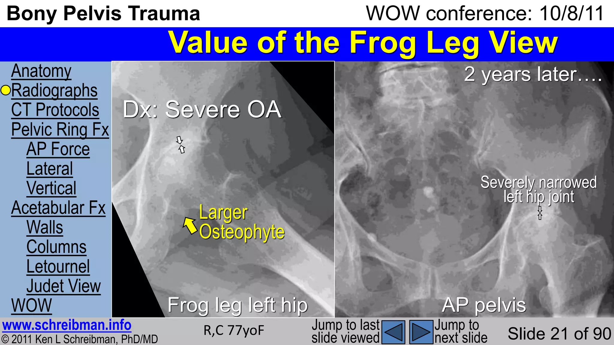 Bony Pelvis Trauma MSK Radiology Lecture | PPSX