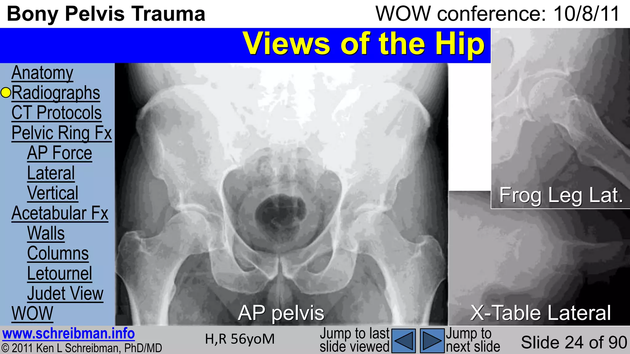 Bony Pelvis Trauma MSK Radiology Lecture | PPSX