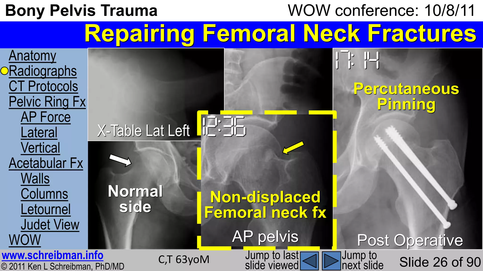 Bony Pelvis Trauma MSK Radiology Lecture | PPSX