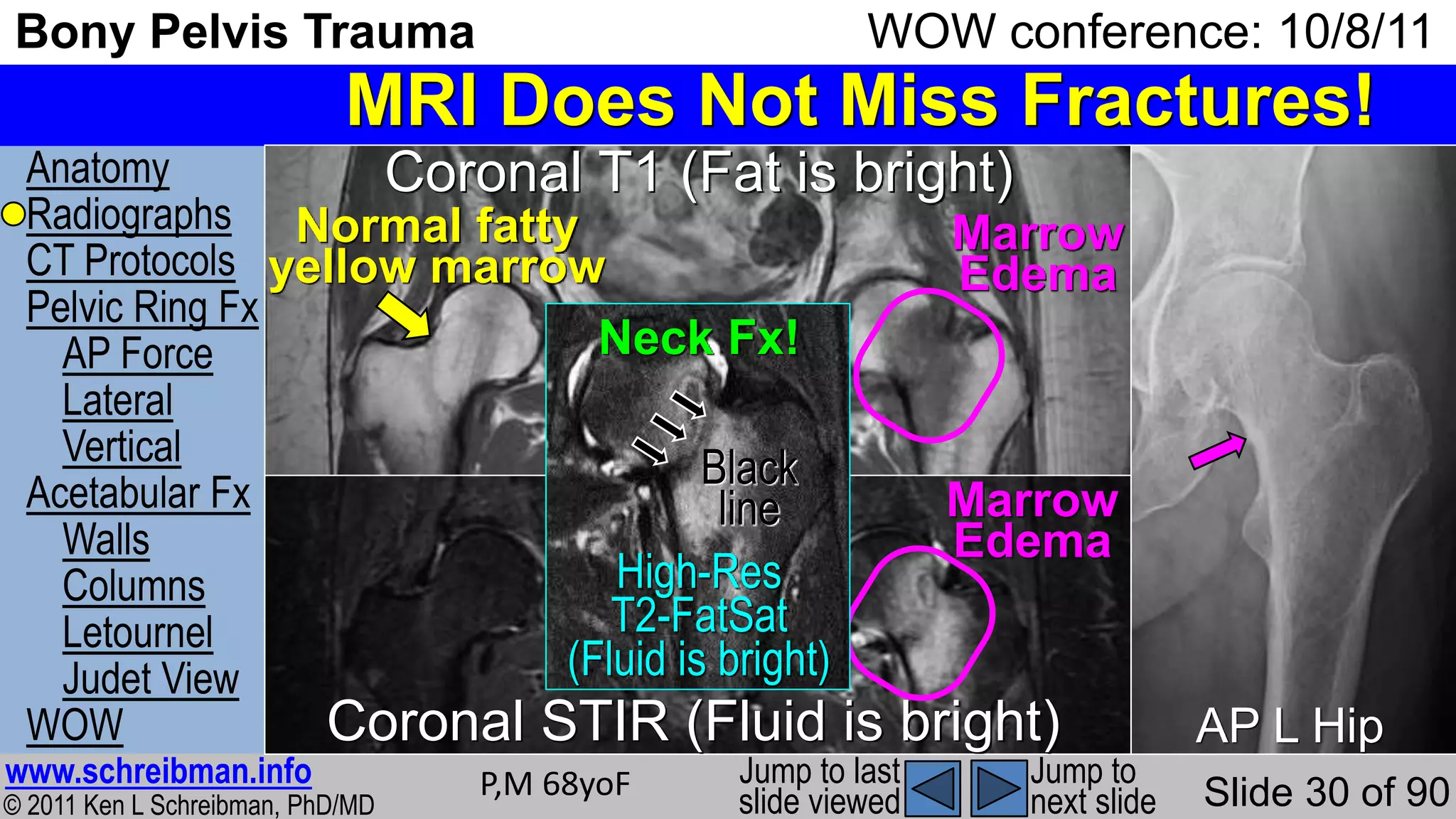 Bony Pelvis Trauma MSK Radiology Lecture | PPSX