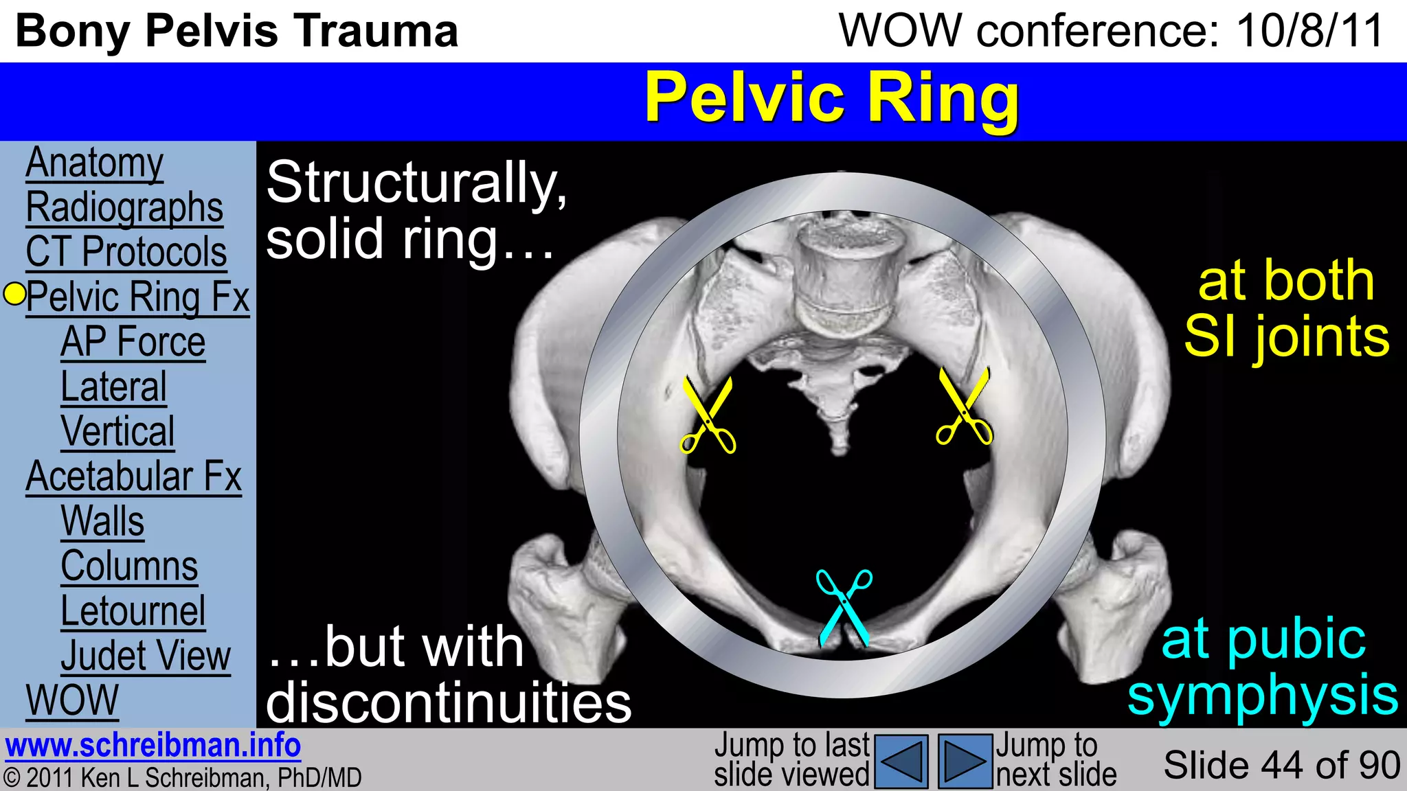 Bony Pelvis Trauma MSK Radiology Lecture | PPSX