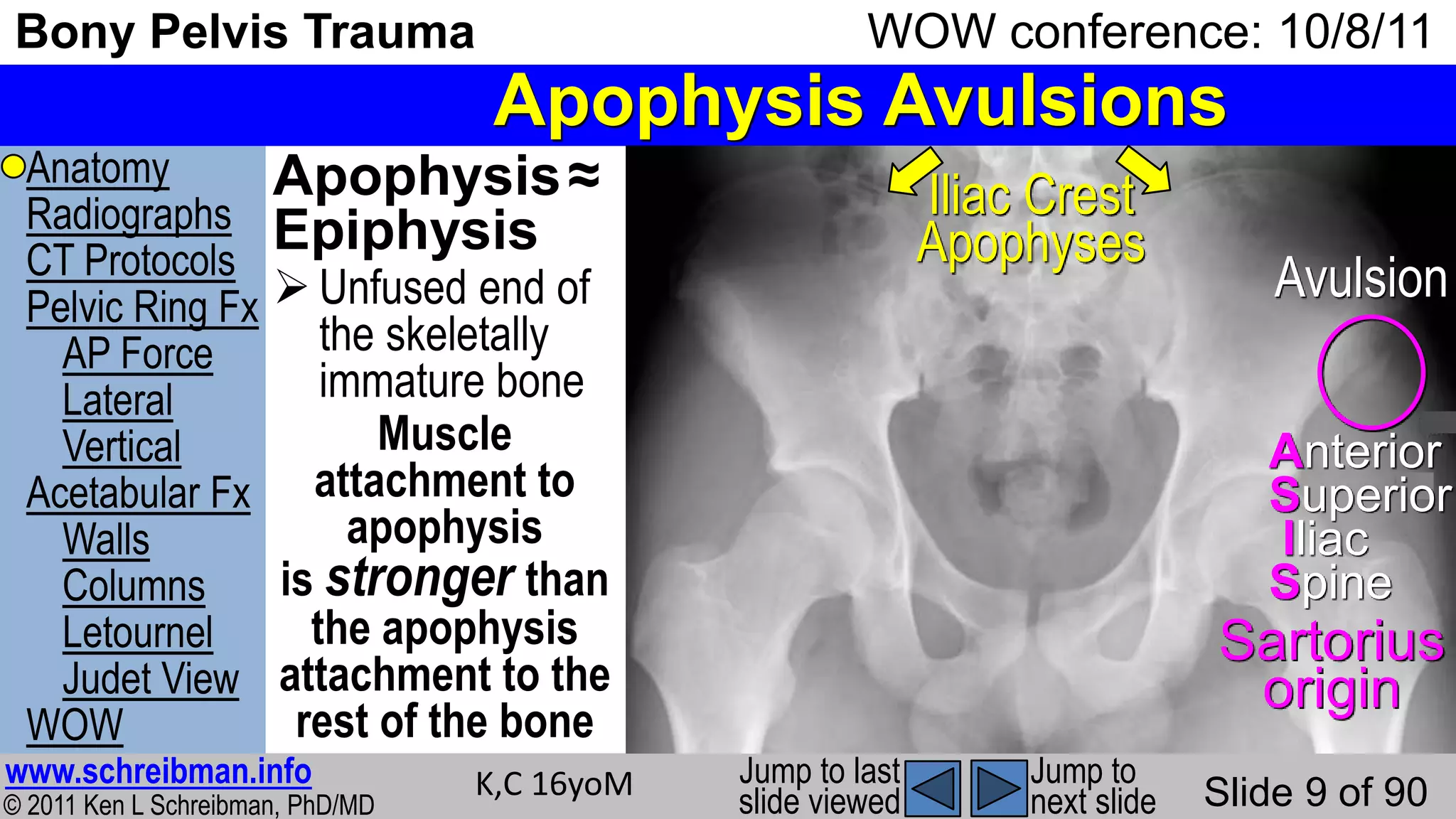 Bony Pelvis Trauma MSK Radiology Lecture | PPSX
