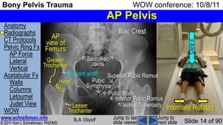 Bony Pelvis Trauma MSK Radiology Lecture | PPSX