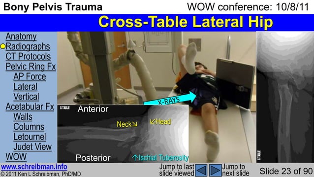 Bony Pelvis Trauma MSK Radiology Lecture | PPT