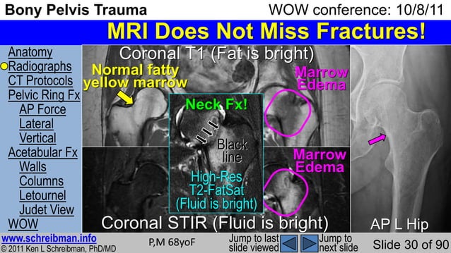 Bony Pelvis Trauma MSK Radiology Lecture | PPT
