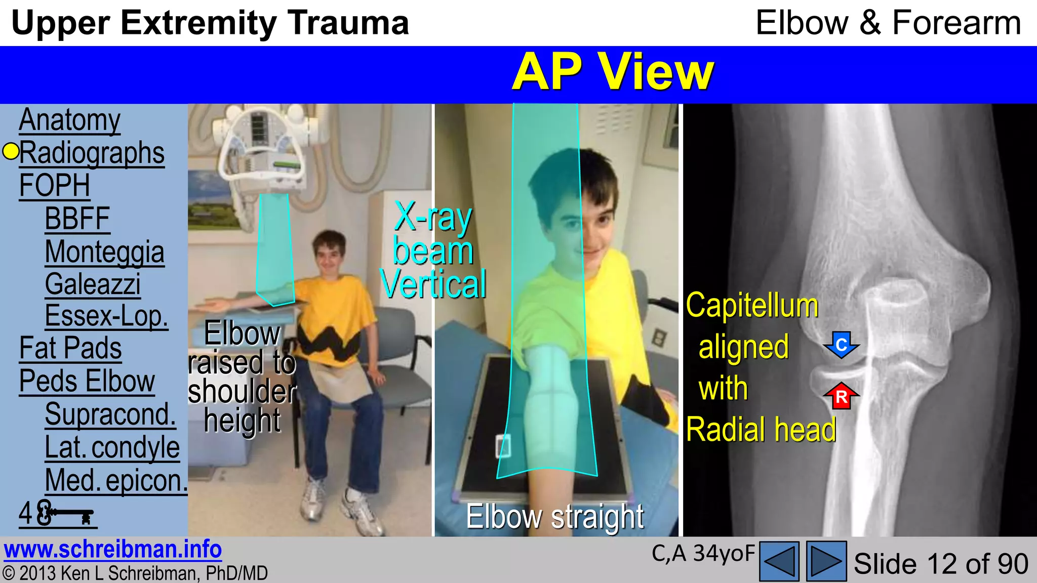 Upper Extremity Trauma Elbow & Forearm MSK Radiology Lecture | PPSX