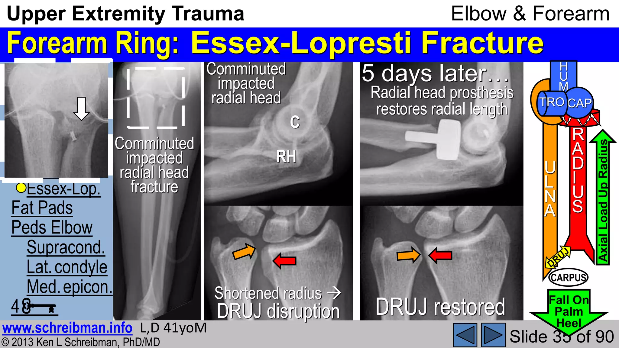 Upper Extremity Trauma Elbow & Forearm MSK Radiology Lecture | PPSX