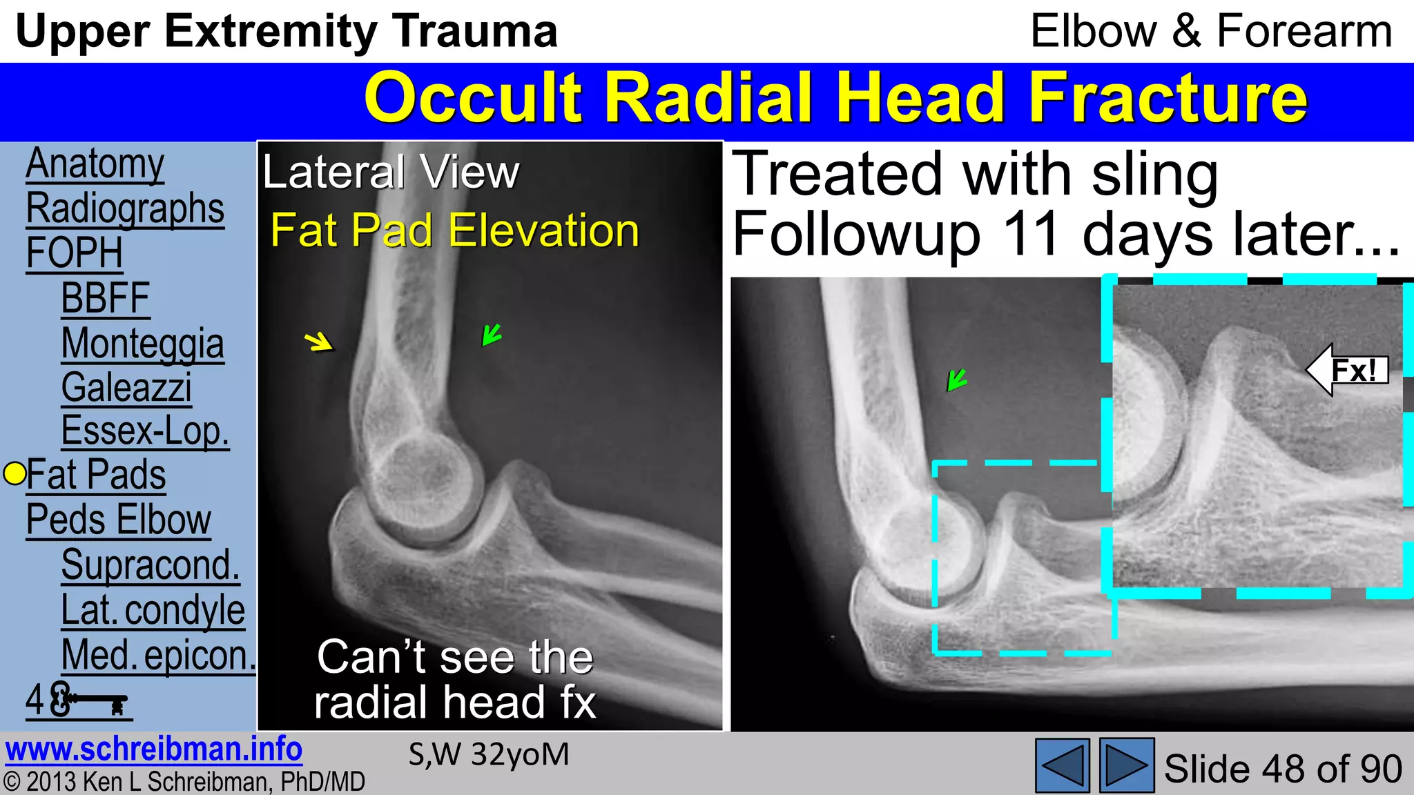 Upper Extremity Trauma Elbow & Forearm MSK Radiology Lecture | PPSX