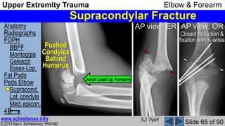 Upper Extremity Trauma Elbow & Forearm MSK Radiology Lecture | PPSX