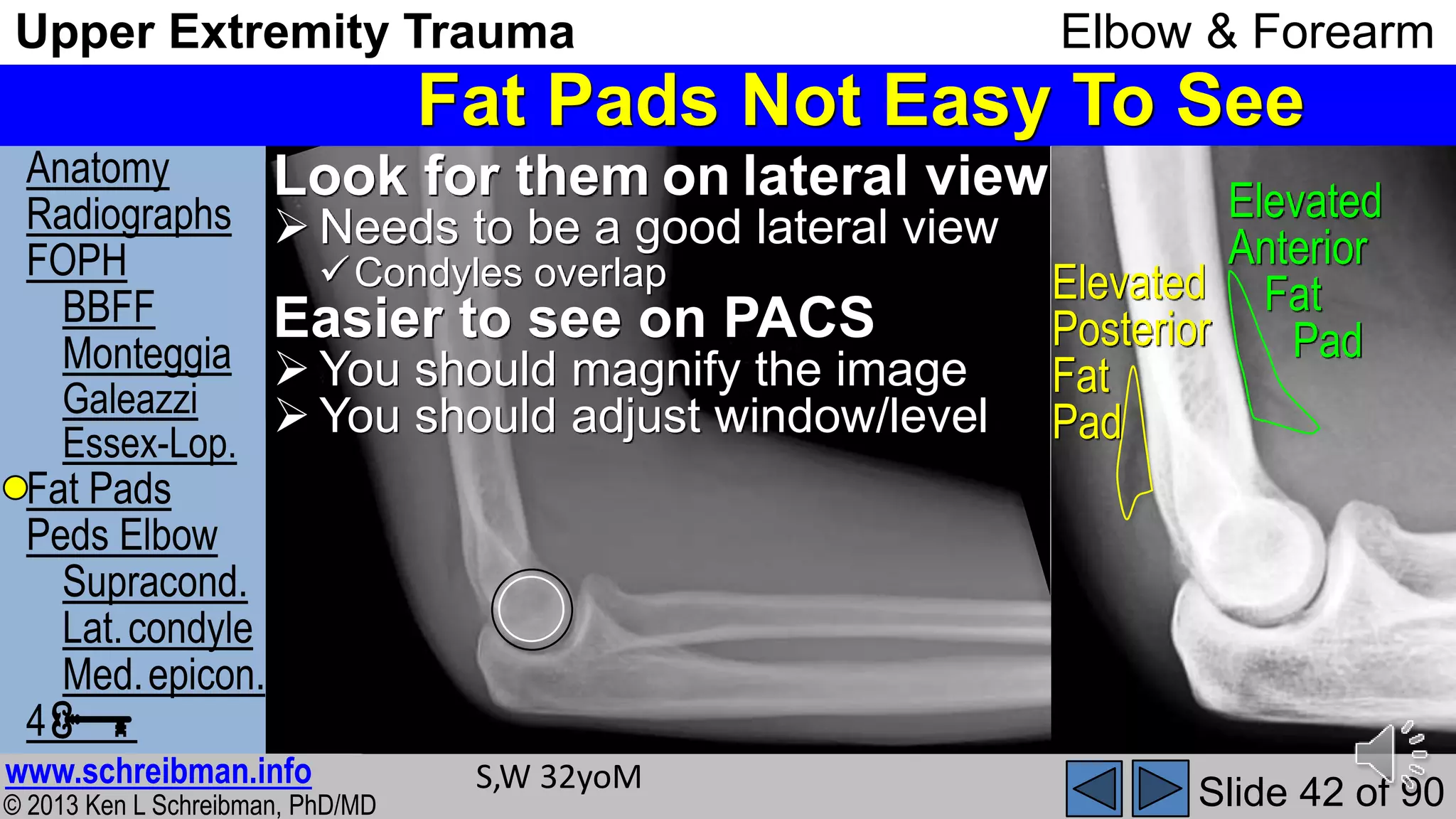 Upper Extremity Trauma Elbow & Forearm MSK Radiology Lecture N | PPT