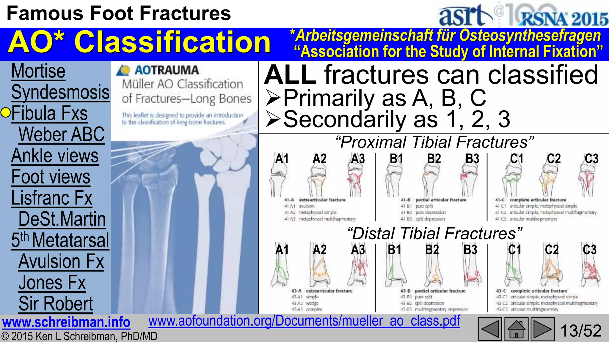Famous foot fractures MSK Radiology Lecture | PPSX