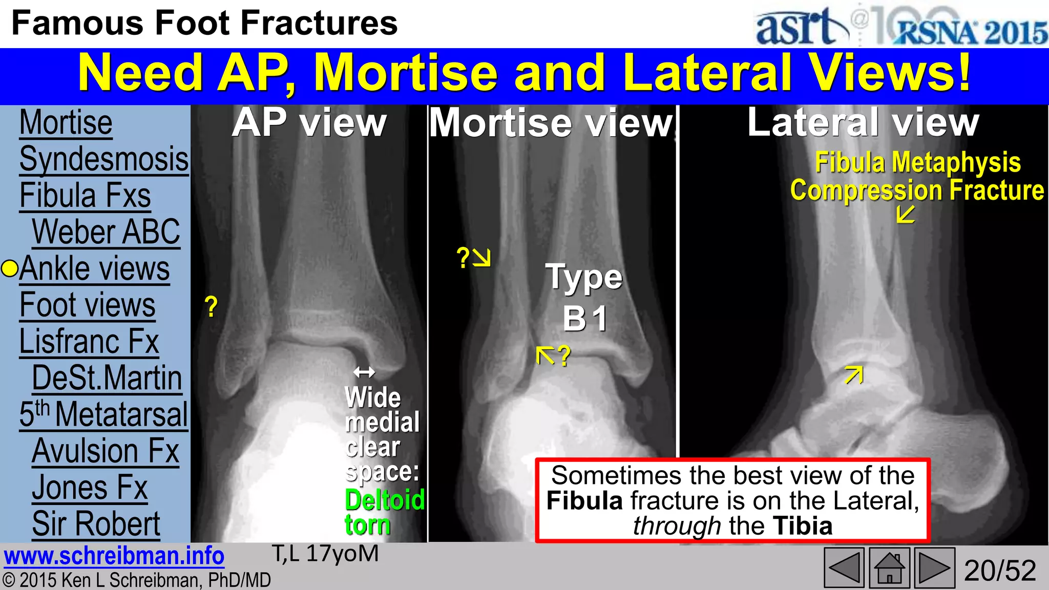 Famous foot fractures MSK Radiology Lecture | PPSX