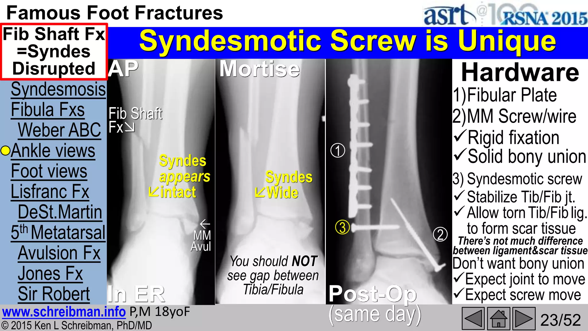 Famous foot fractures MSK Radiology Lecture | PPSX