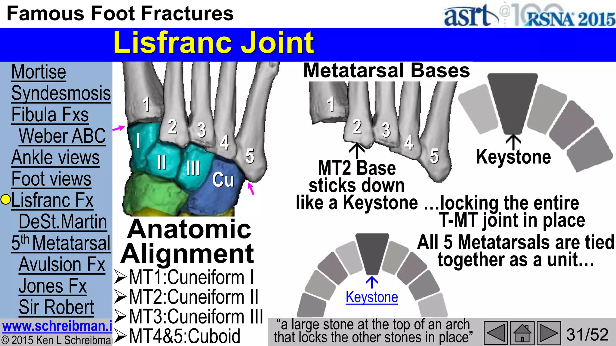 Famous foot fractures MSK Radiology Lecture | PPSX | Death, Injury, or ...