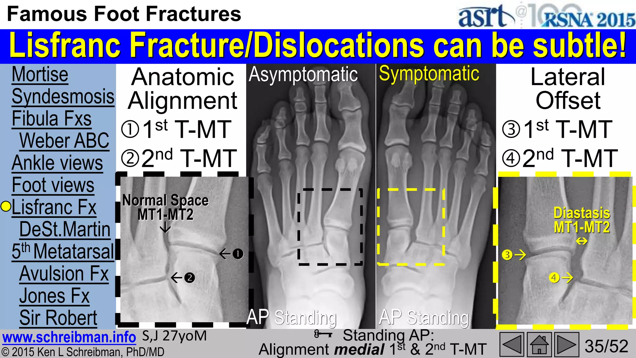 Famous foot fractures MSK Radiology Lecture | PPSX | Death, Injury, or ...