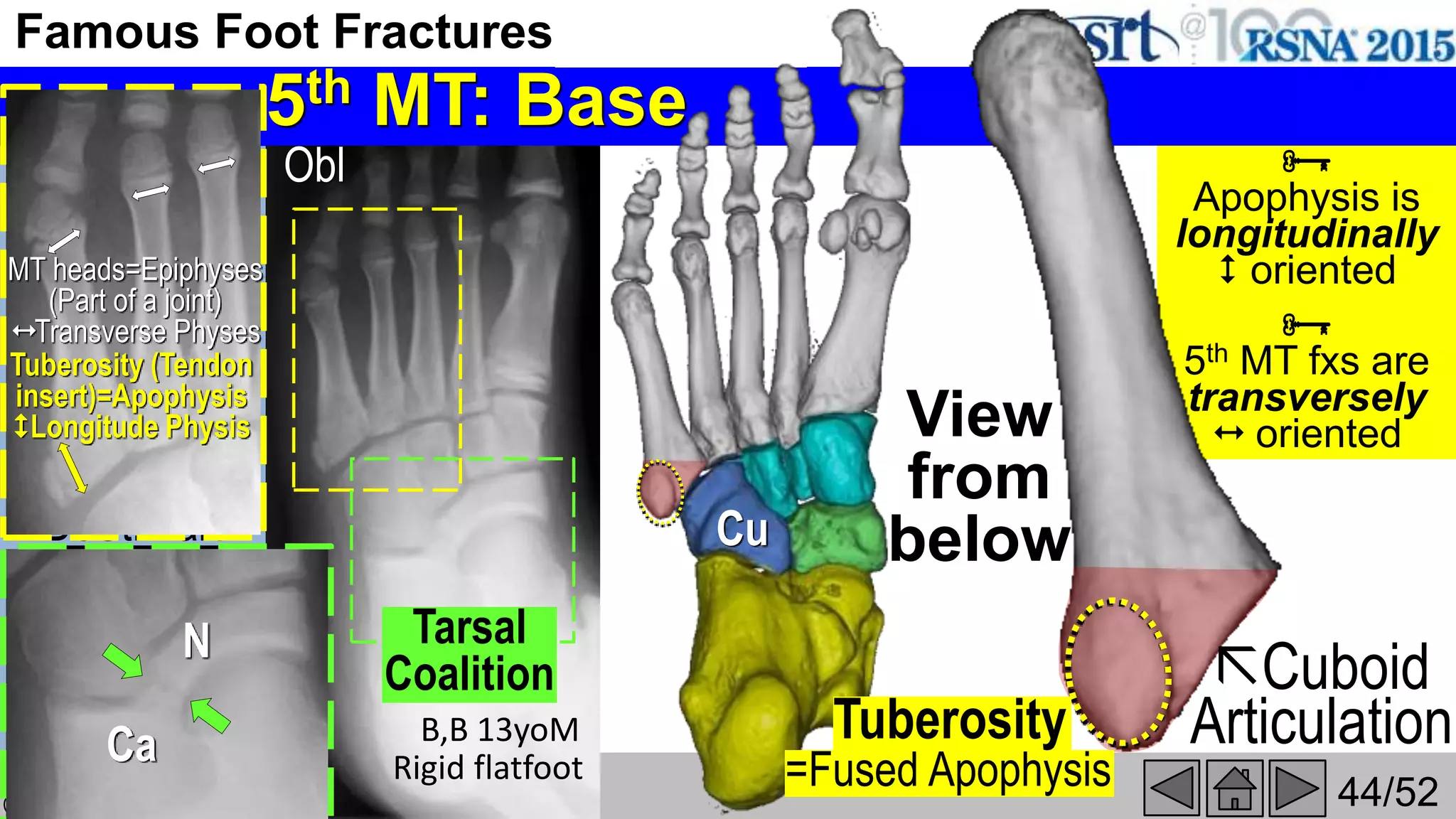 Famous foot fractures MSK Radiology Lecture | PPSX | Death, Injury, or ...