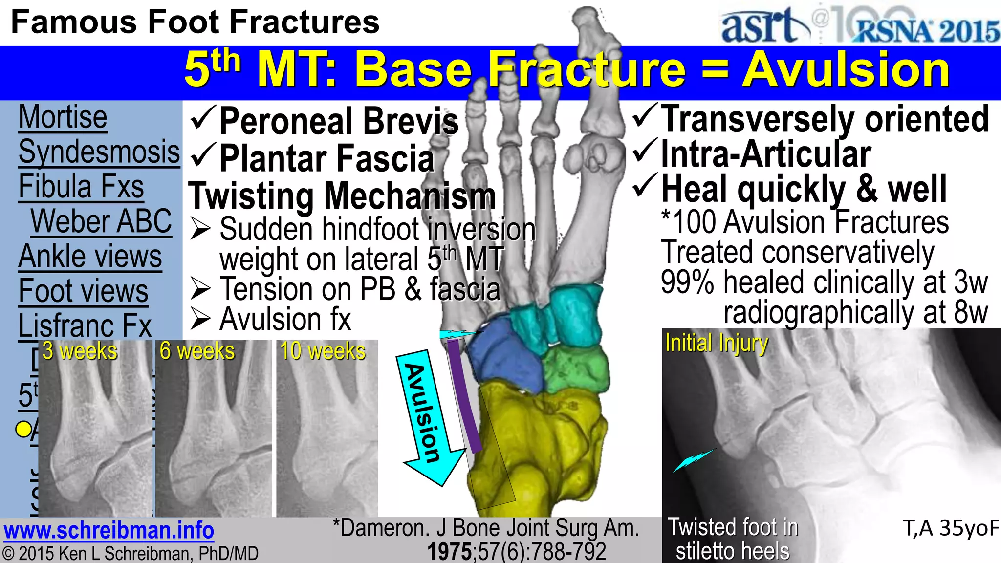 Famous foot fractures MSK Radiology Lecture | PPSX | Death, Injury, or ...