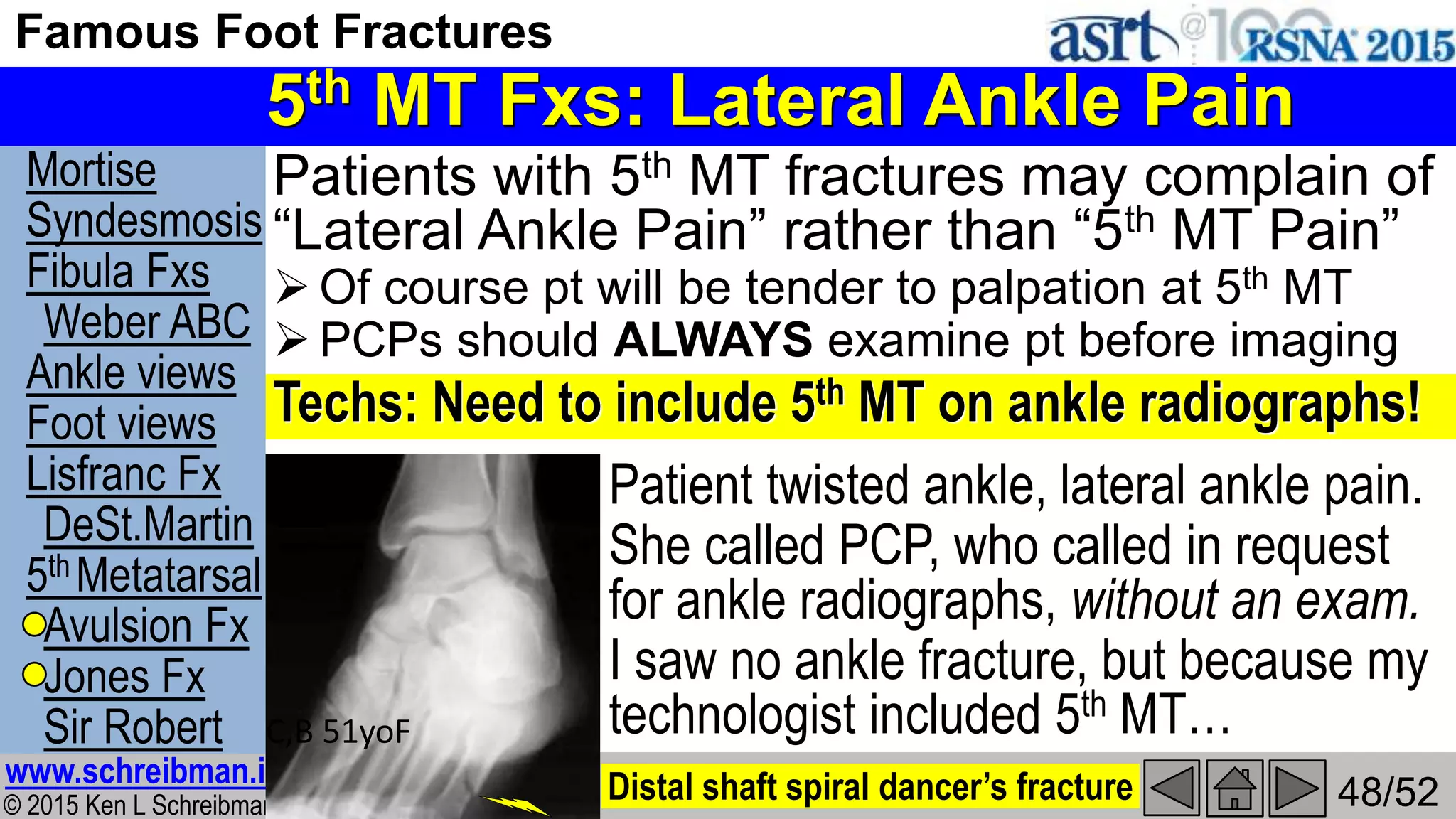 Famous foot fractures MSK Radiology Lecture | PPSX | Death, Injury, or ...