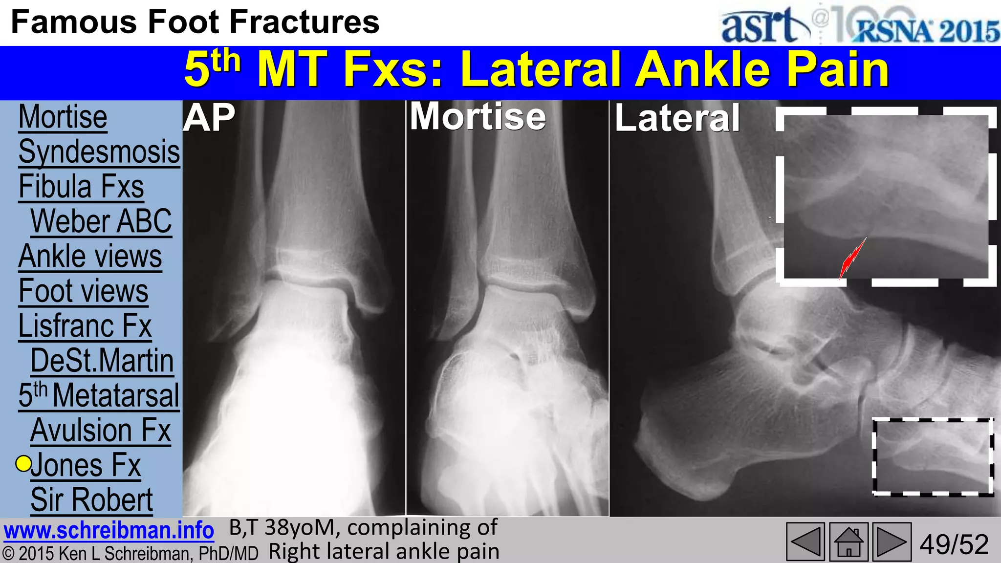 Famous foot fractures MSK Radiology Lecture | PPSX | Death, Injury, or ...