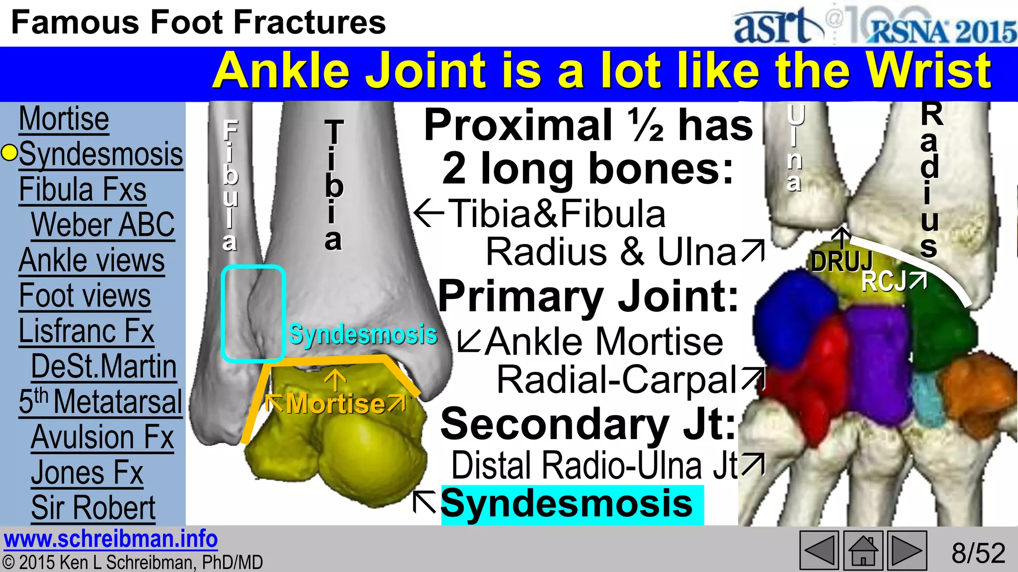 Famous foot fractures MSK Radiology Lecture | PPSX