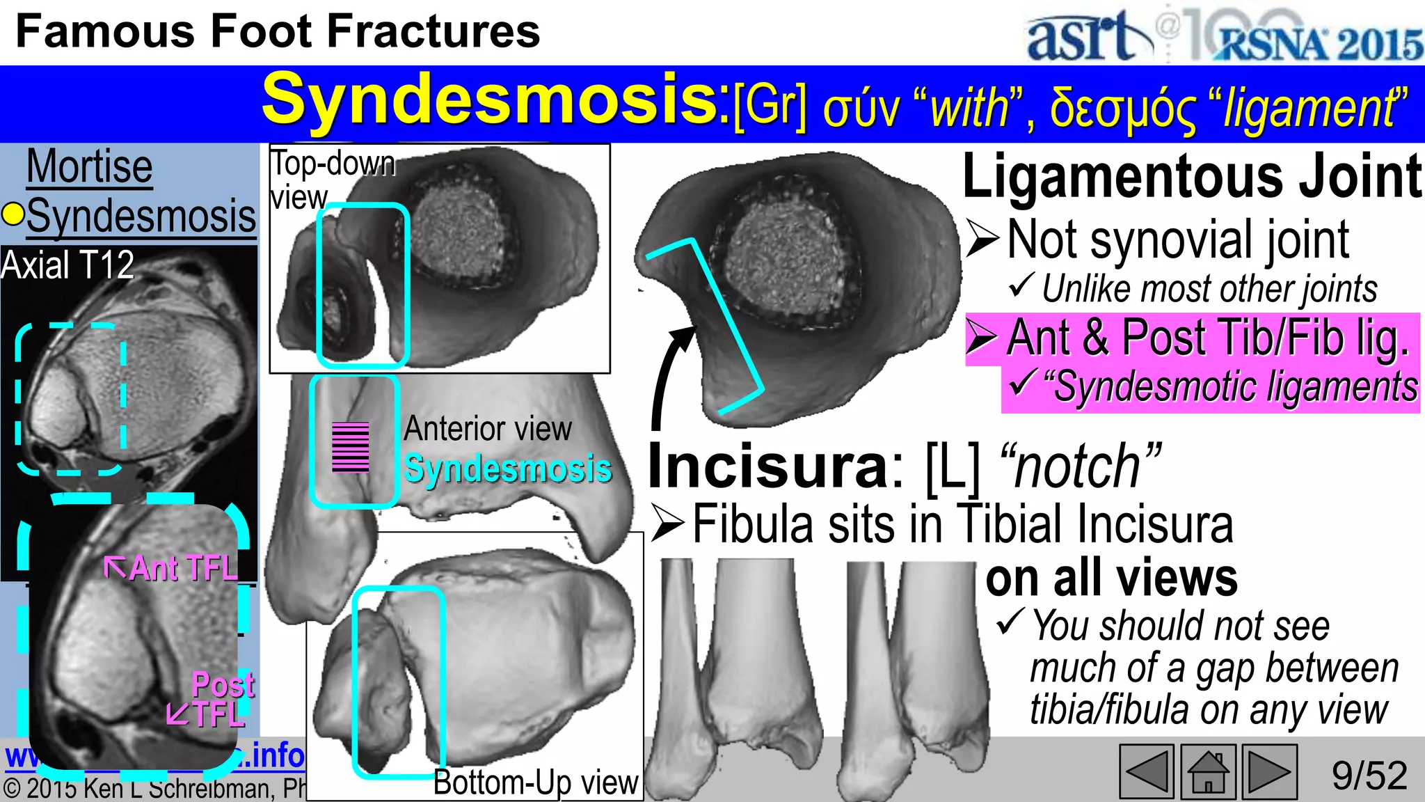 Famous foot fractures MSK Radiology Lecture | PPSX