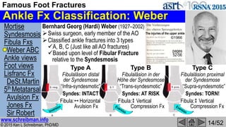 Famous foot fractures MSK Radiology Lecture | PPSX