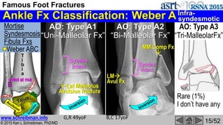 Famous foot fractures MSK Radiology Lecture | PPSX