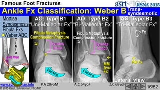 Famous foot fractures MSK Radiology Lecture | PPSX