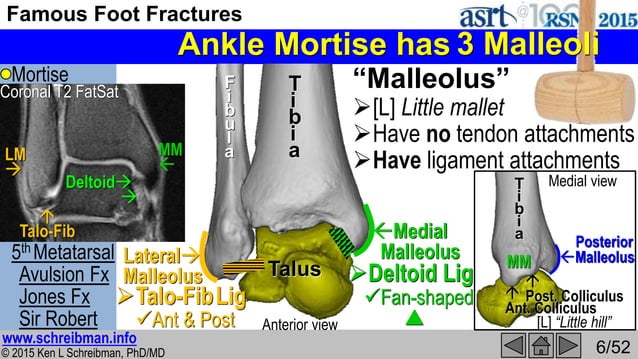 Famous foot fractures MSK Radiology Lecture | PPSX | Death, Injury, or ...