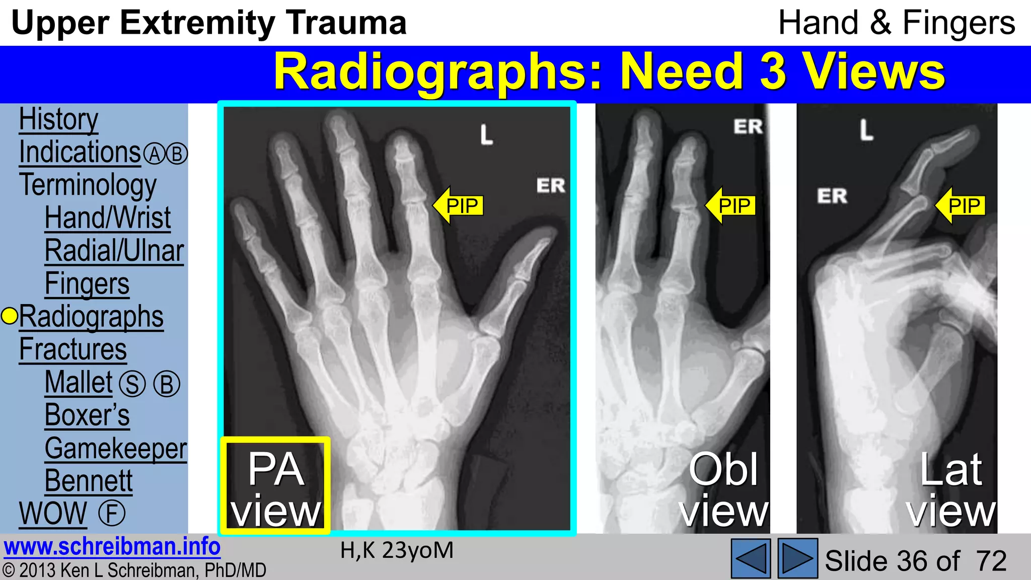 Upper Extremity Trauma MSK Radiology Lecture | PPT | Free Download