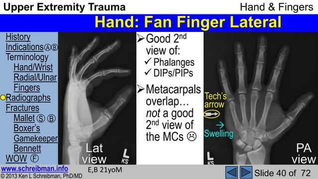 Upper Extremity Trauma MSK Radiology Lecture | PPT