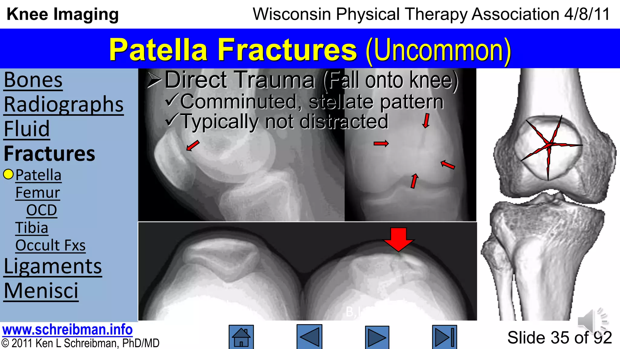 Knee Imaging narrated MSK Radiology Lecture | PPT