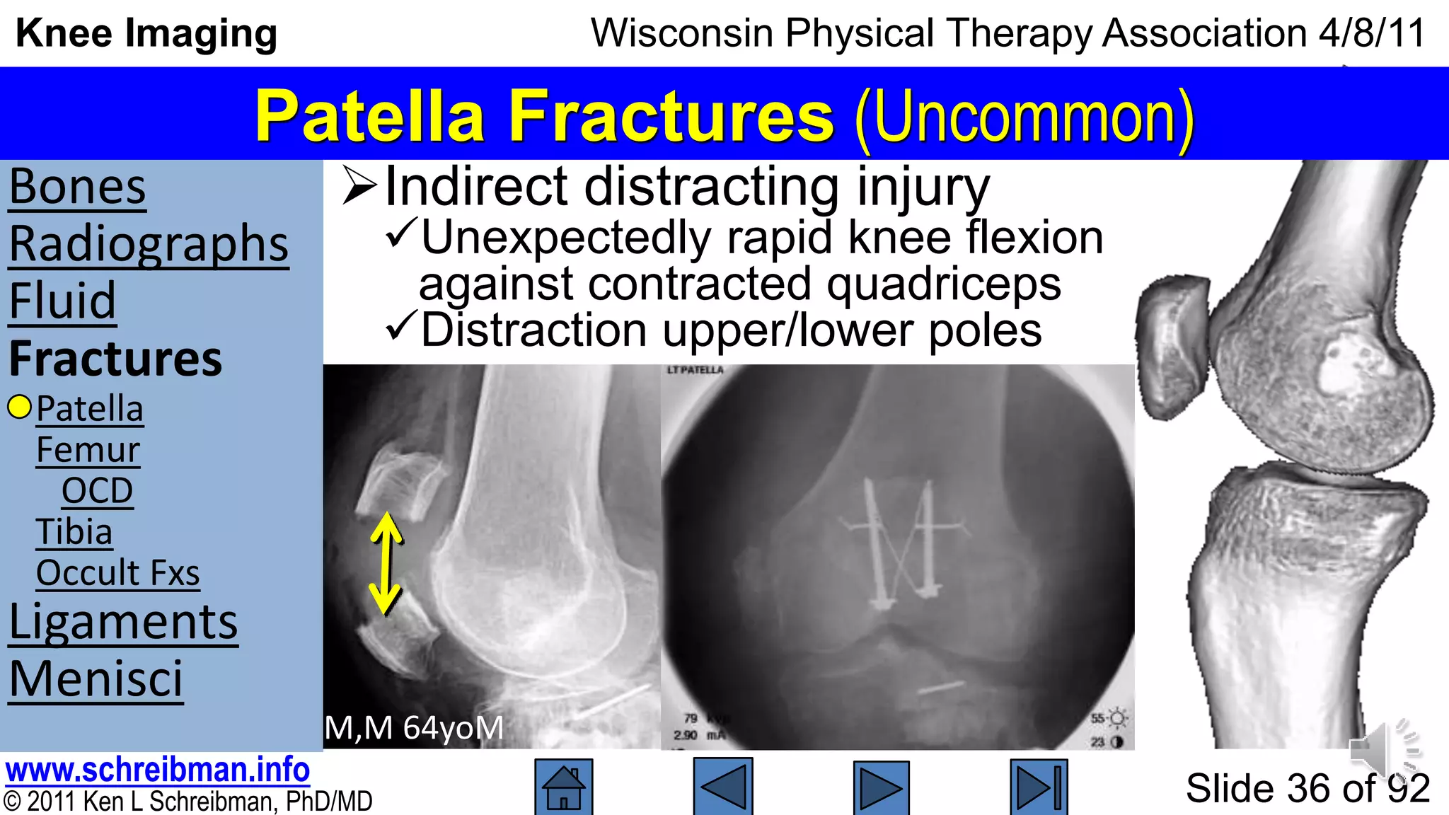 Knee Imaging narrated MSK Radiology Lecture | PPT