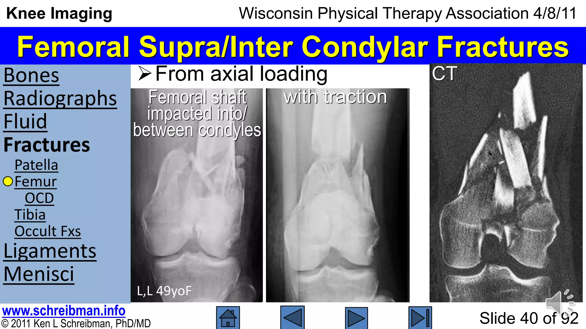 Knee Imaging narrated MSK Radiology Lecture | PPT