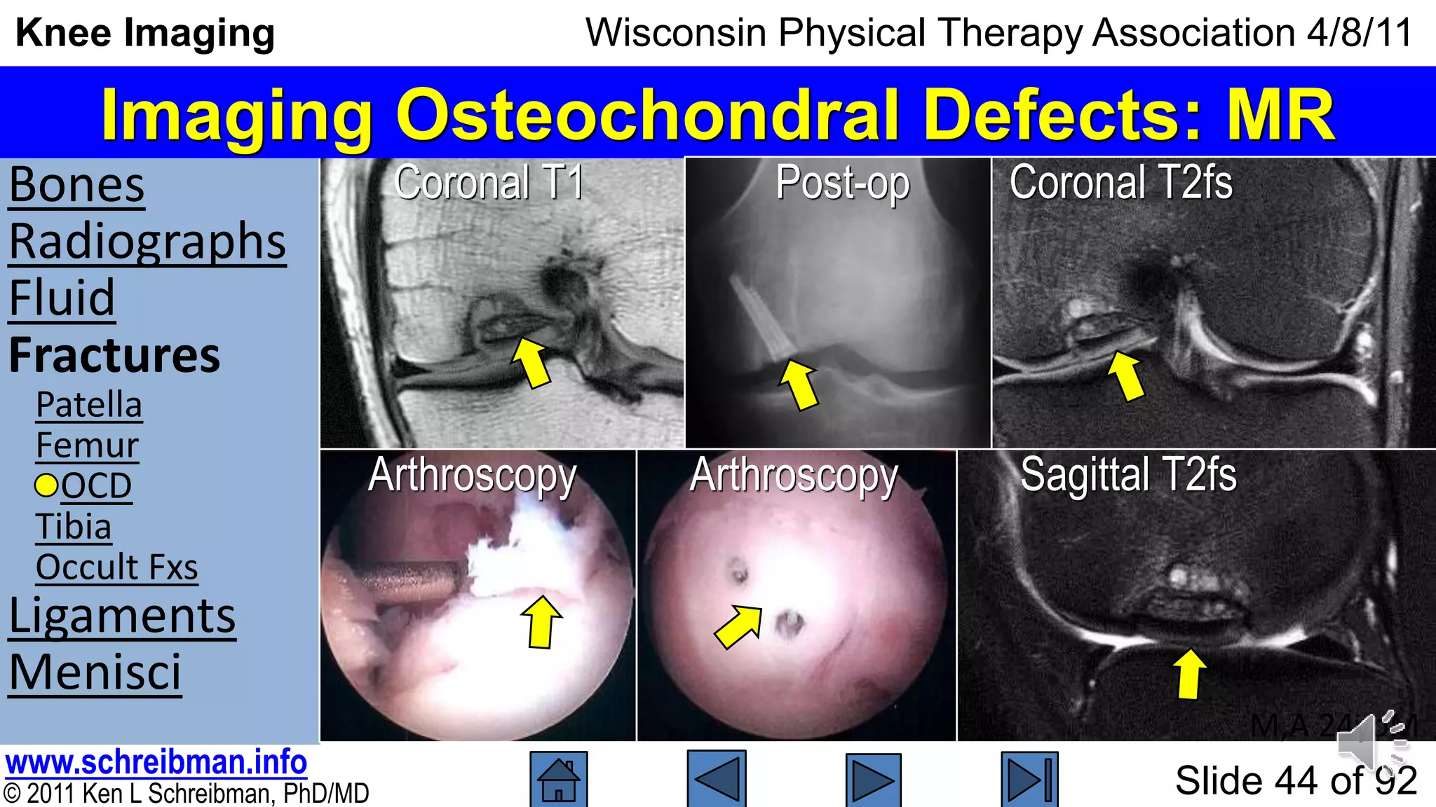 Knee Imaging narrated MSK Radiology Lecture | PPT